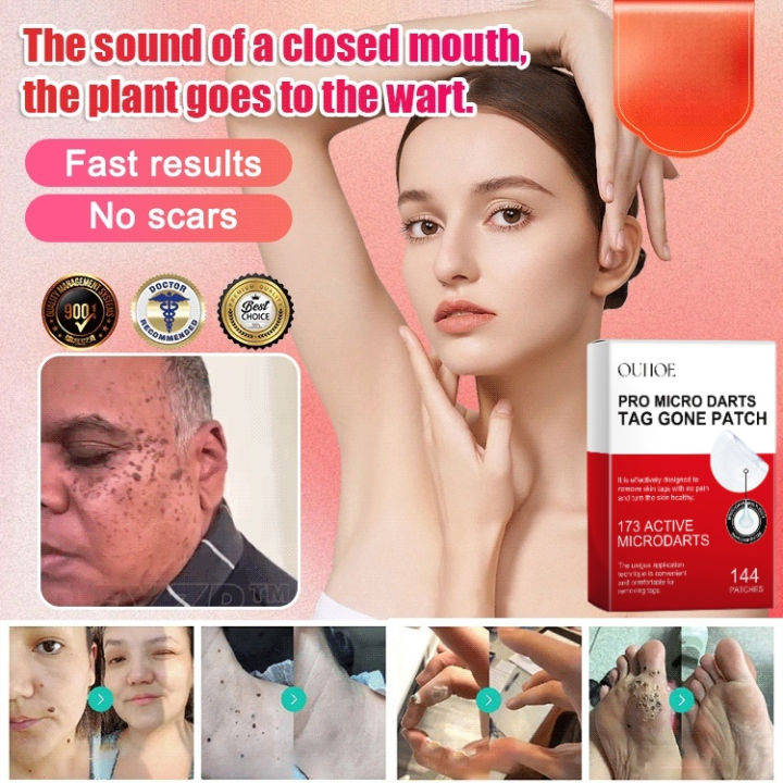 Skin patch treatment for skin warts instant plant cleansing | Lazada