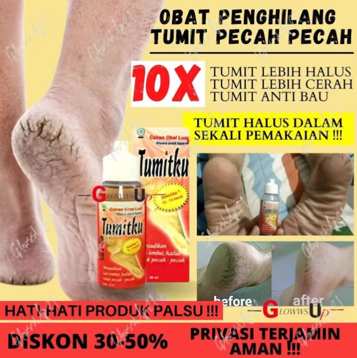 TUMITKU OBAT KAKI PECAH TUMITKU 30ML OBAT HERBAL MENGATASI KAKI PECAH ...