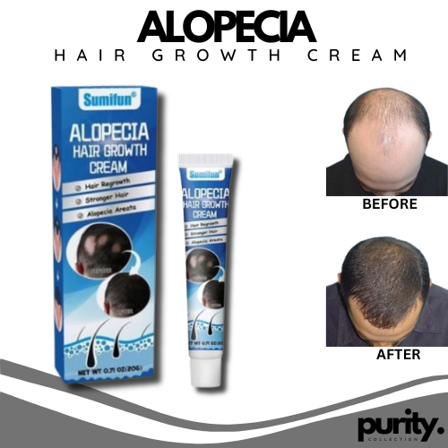 Alopecia Hair Growth Cream Anti Hair Loss Hair Treatment, Baldness ...