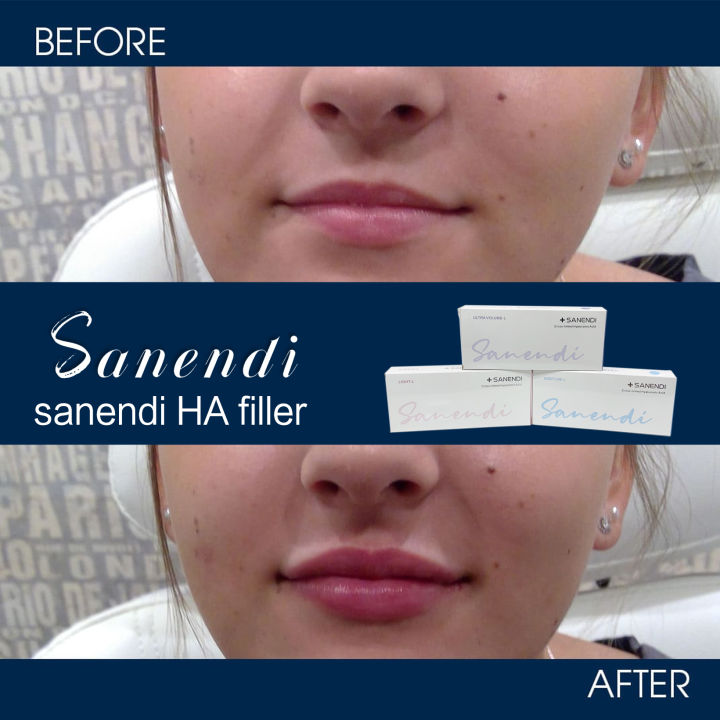 Sanendi Filler Lip augmentation, nose bridge augmentation, chin shaping ...