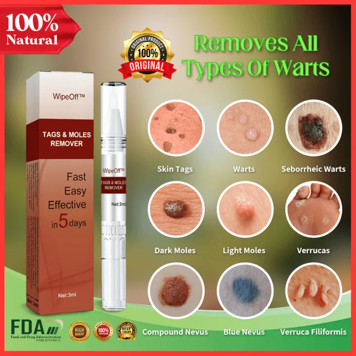 Warts Remover Cream Original Watson Warts Removal Mole Remover Organic ...