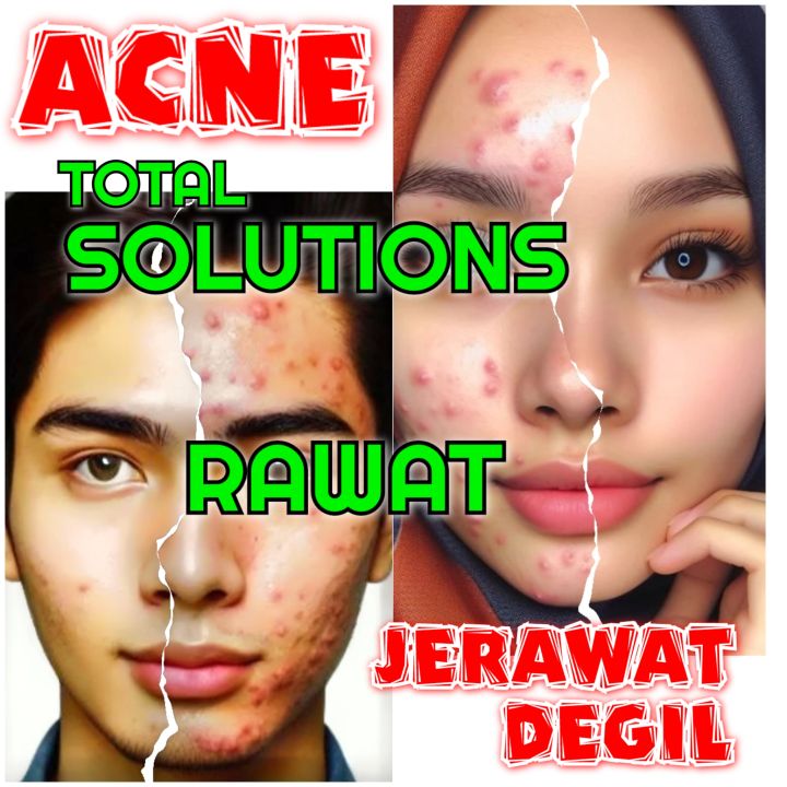 Gel Jerawat Terbaik Anti BreakOut Pimples Gel Pimples Topical Treatment ...