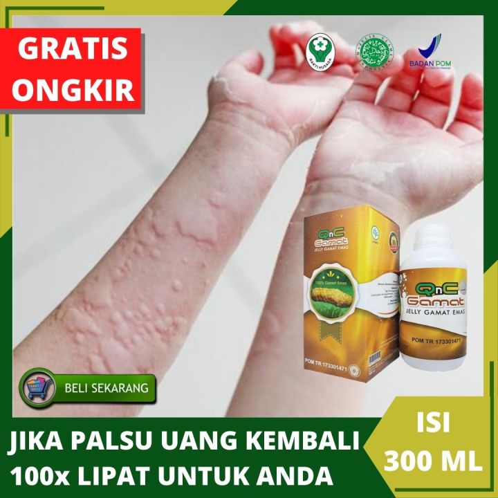 Obat Alergi Kaligata, Obat Gatal-Gatal Kaligata, Obat Mengatasi Biduran ...