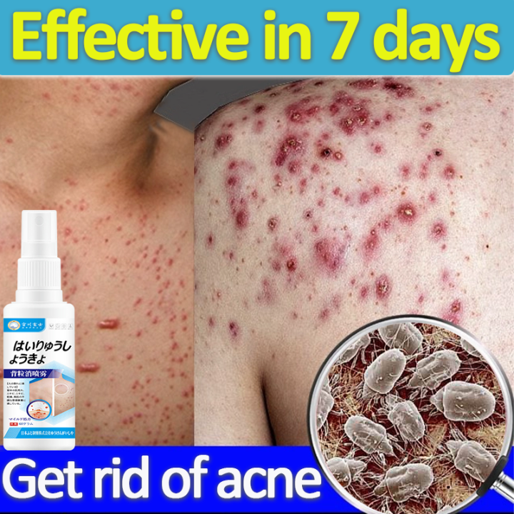 Back Anti-Acne Spray Acne Spray 60ml remove Acne Relieve inflammation ...