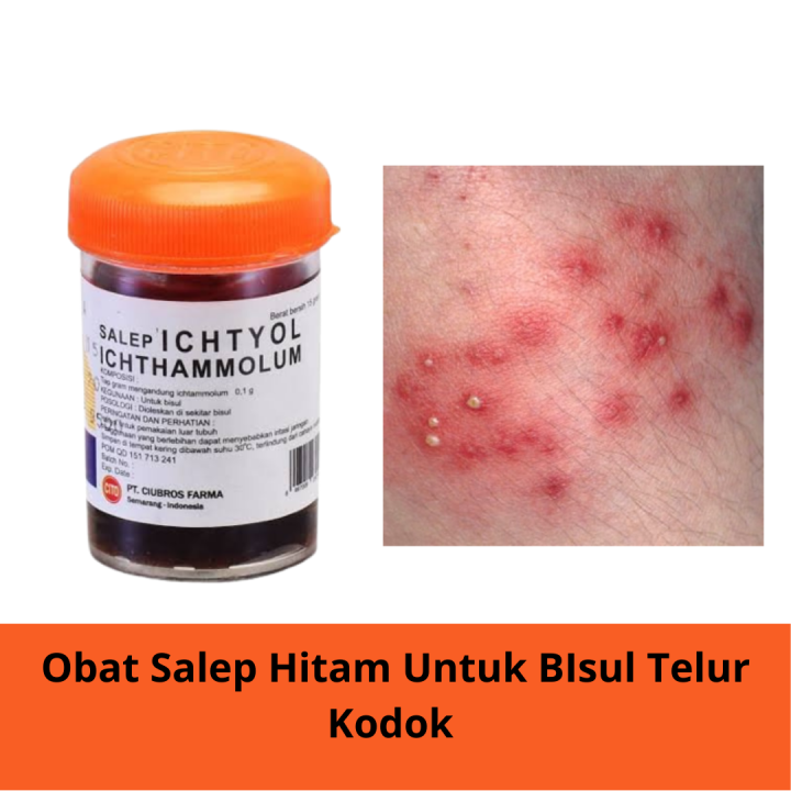 Salep Bisul Telur Kodok Bisul Bernanah Bisul Di Punggung Kaki Tangan ...