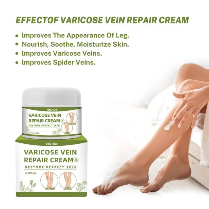 Varicose vein cream leg swelling care cream 50g Varicosity Angiitis ...