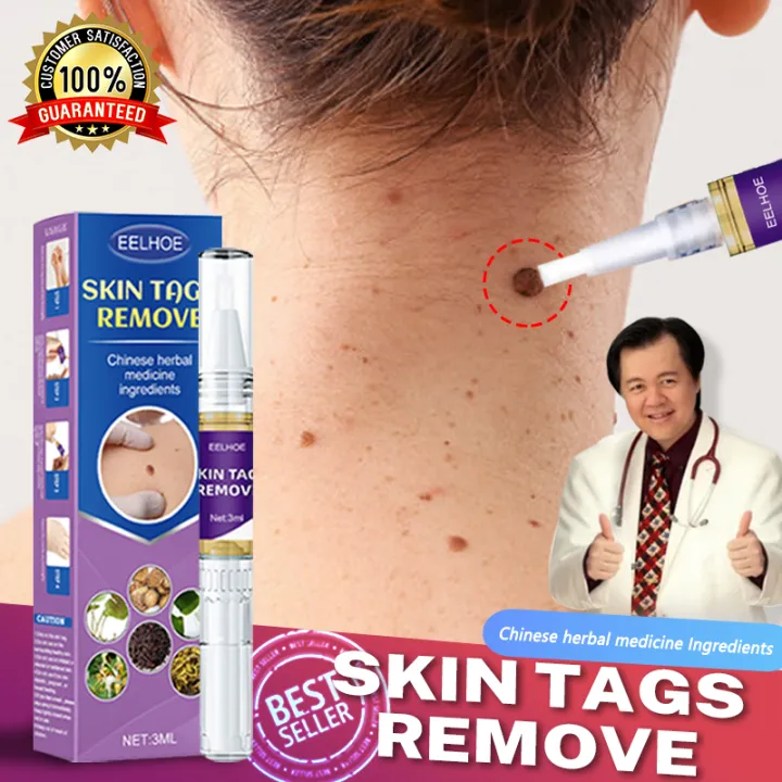 Warts Flat Eliminate Wart Pen 20gWart Liquid Hand Foot Warts Remove ...