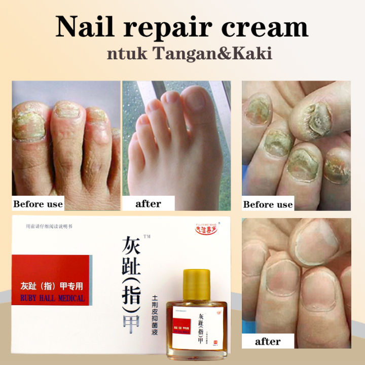 Krim Kuku Jamur Nail fungus treatment cream Prompt restoration of ...