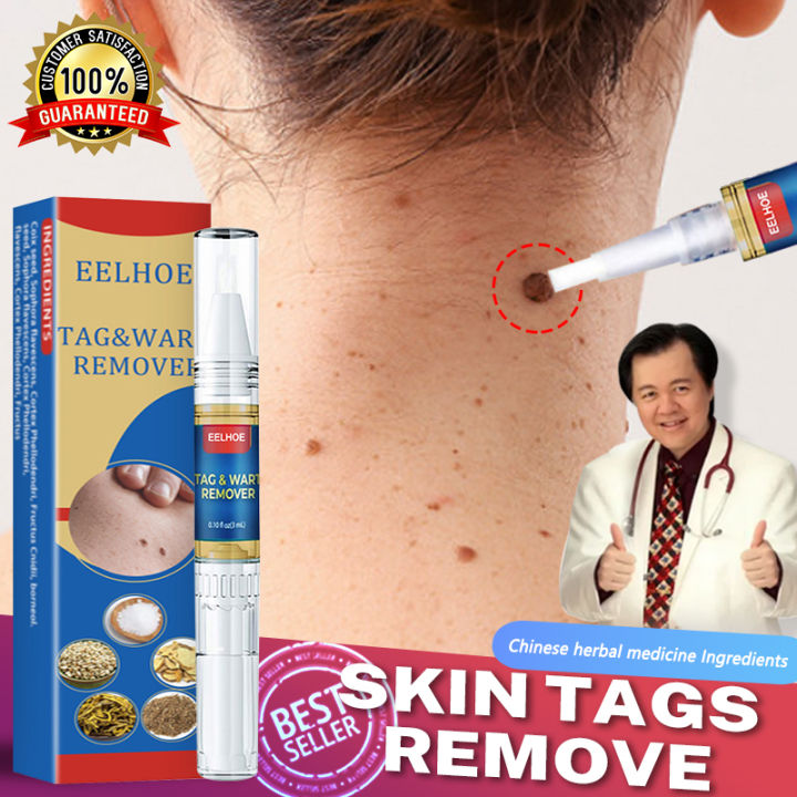 Original Warts Remover Watson Warts Removal Mole and Warts Remover Skin ...
