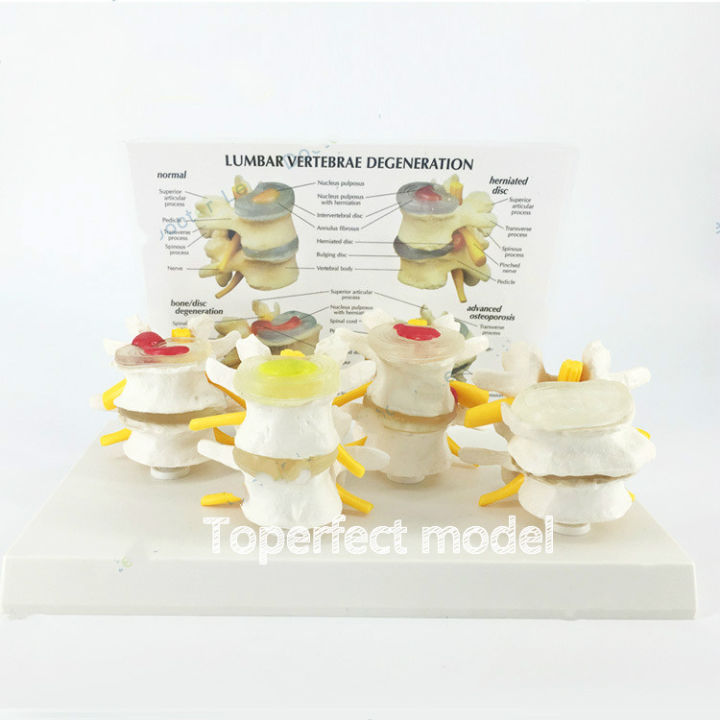 Medical Normal Lumbar Spine Lesion Combined Anatomical Model ...