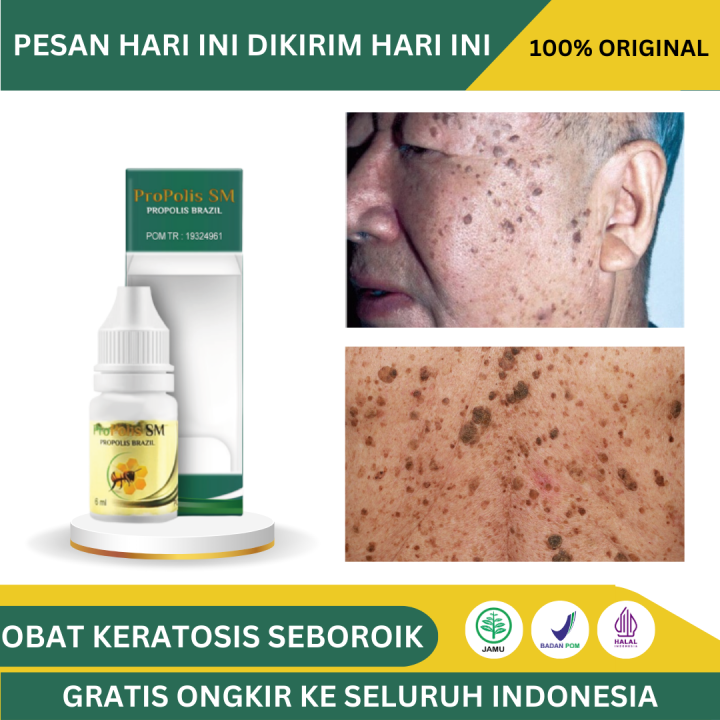 Obat Keratosis Seboroik, Penghilang Bintik Hitam Seperti Kutil Di Wajah ...