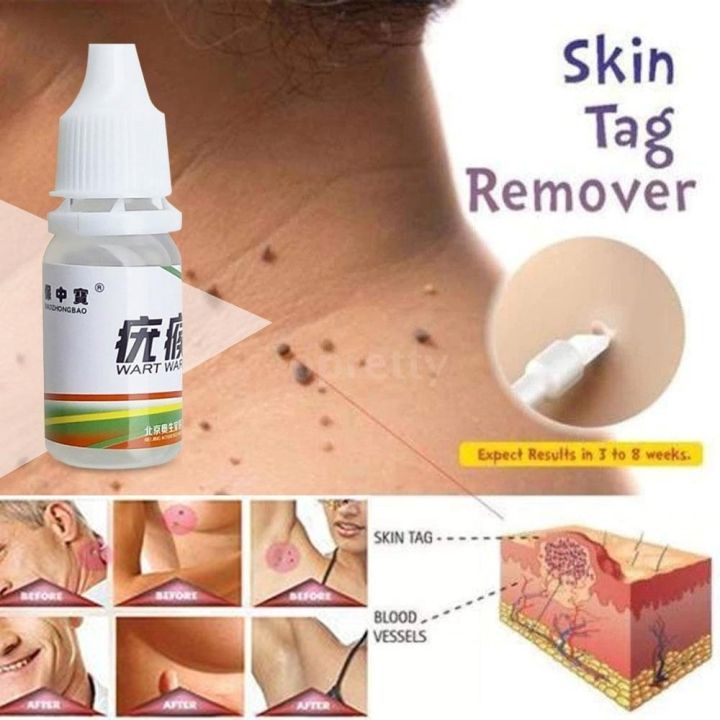 Skin Tag Remover Medical Tu Kill Remover Warts Treatment Foot Corn ...