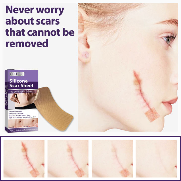 Scars Heal Treatment for Old New Scars 8Pcs Silicone Scar Sheets Safety ...