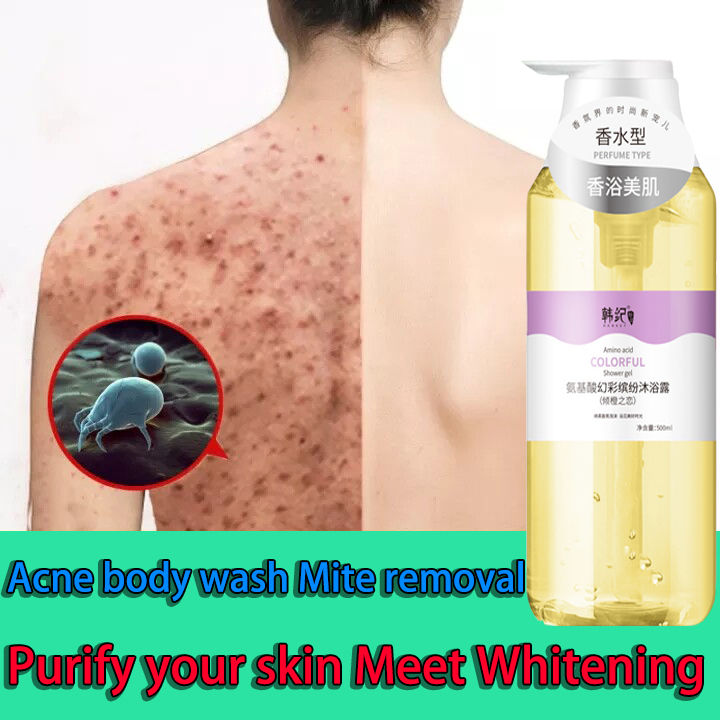 【New store promotion for one month】Eczema Treatmen Remove Acne Mites ...