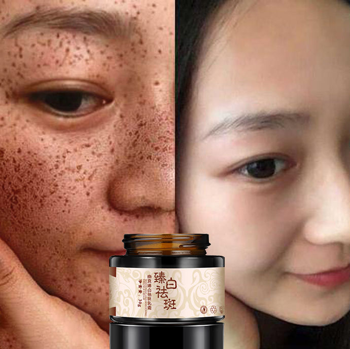 Freckle Remover Face Cream Whitening Face Brightening Dark Spot Freckle ...