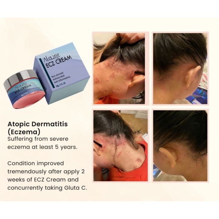 ♬Natural cream made from plants for Eczema Psoriasis Antifungal Non ...