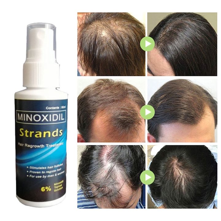 Minoxidil Strands 6% Minoxidil Topical Solution (60ml per bottle) Hair ...