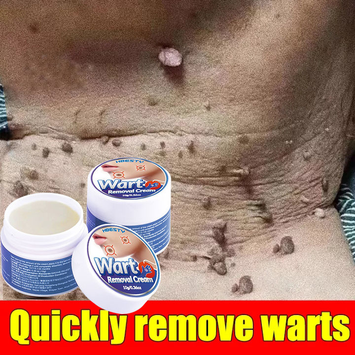 Warts Remover Original Cream 10g Warts Magic Remover Wartz Removal ...