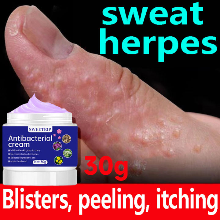 South Moon Eczema Cream Skin Itching Cream Herbal Antibacterial Agent ...