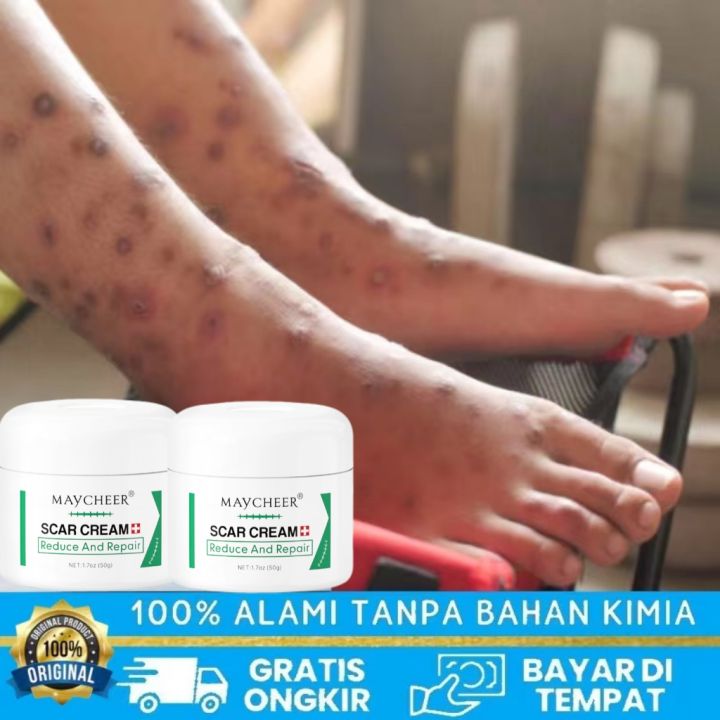 Original Scar Remover Cream Peklat Remover Cream Repairs Whole Body ...