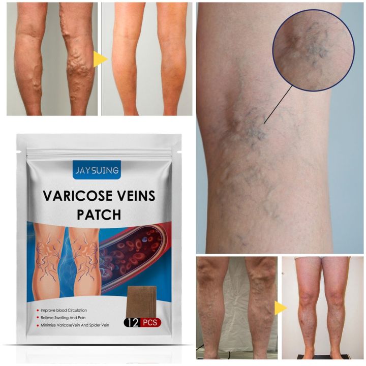 ORIGINAL VARICOSE VEIN PATCH | Lazada PH