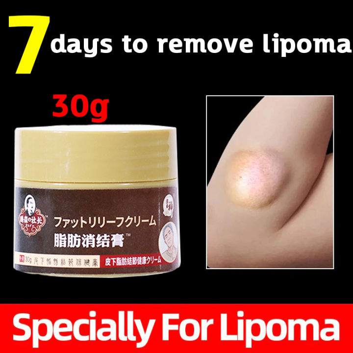 lipoma removal cream 30g original lipoma cream bukol original lipoma ...