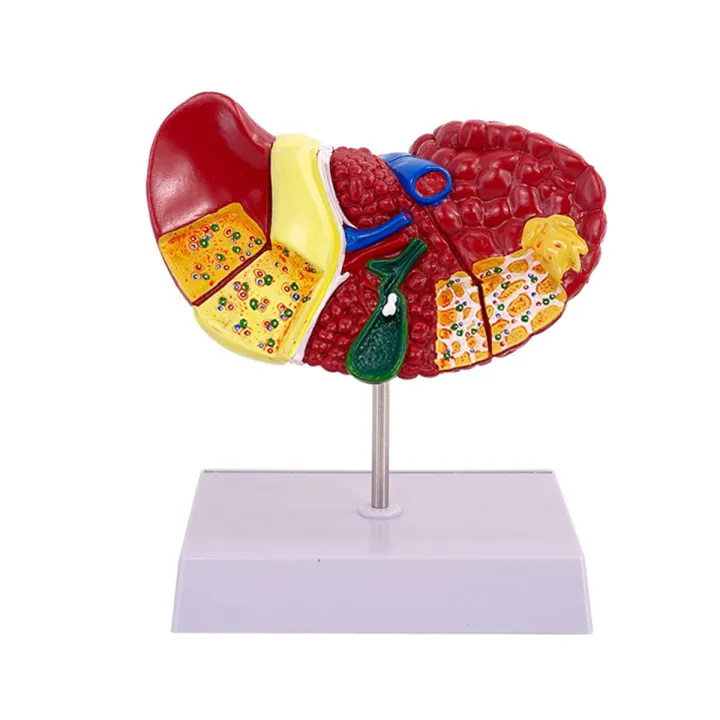 Human Anatomy Liver Model for Common Pathologies, Liver Model Human ...