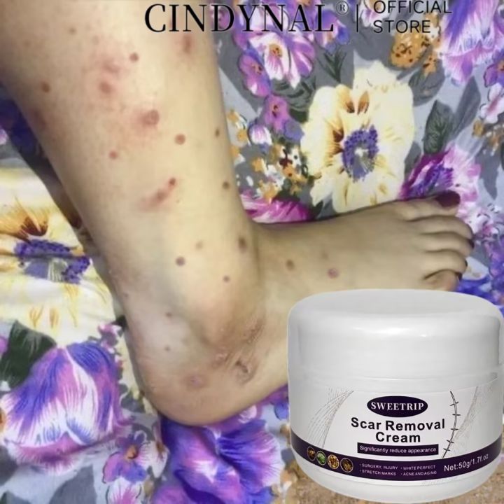 CINDYNAL Scar cream 50g For Old And New Scar Face and Body Skin Repair ...