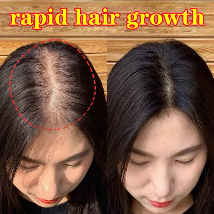 【Hot in Japan】28 Days Hair Regrowth Tonic Hair Regrowth Essence Hair ... 【Hot in Japan】28 Days Hair Regrowth Tonic Hair Regrowth Essence Hair ...