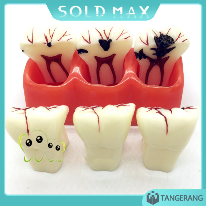 Model Karies Gigi Dental 4 Kali/Model Gigi Karies Edukasi Patologi ...