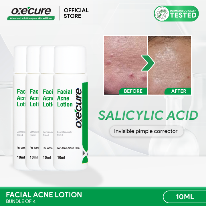 OXECURE 2% Salicylic Acid Facial Acne Lotion 10ml Bundle of 4 | Lazada PH