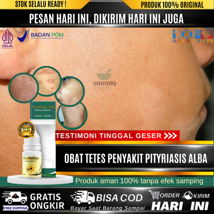 Obat Pityriasis Alba Untuk Anak dan Dewasa, Penghilang Bercak Merah Di ...