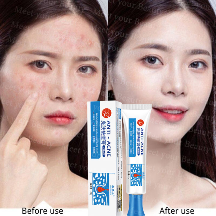 100% Effective Remove Pimples Quickly Pimple Remover Acne Cream Fades Acne Marks Repairs Acne ...