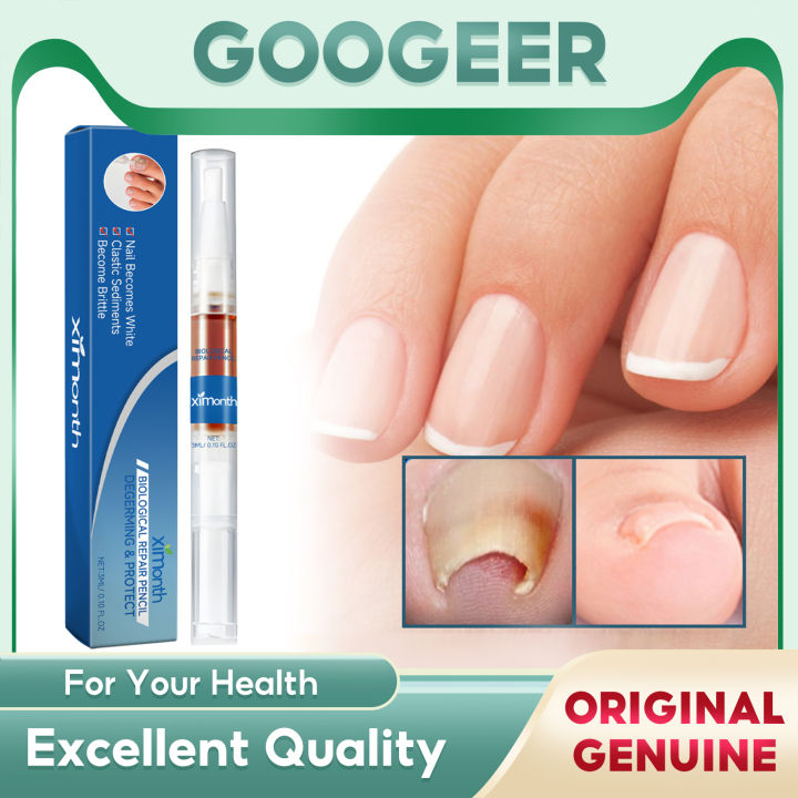 Ximonth Nail Repair Liquid Pen Fungus Treatment Anti Fungal Solution ...