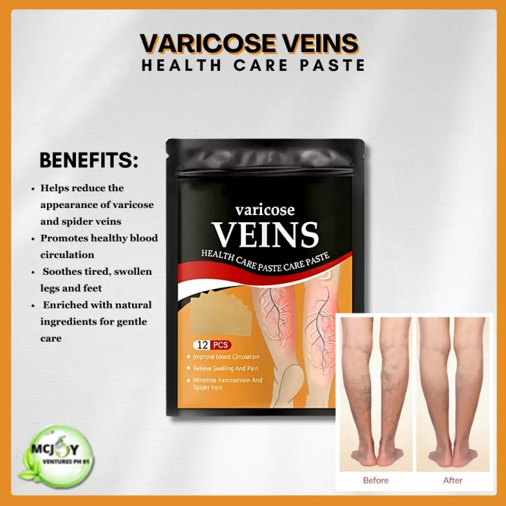 Varicose Vein Remover Patch Effective Pain Relief Varicose Veins ...