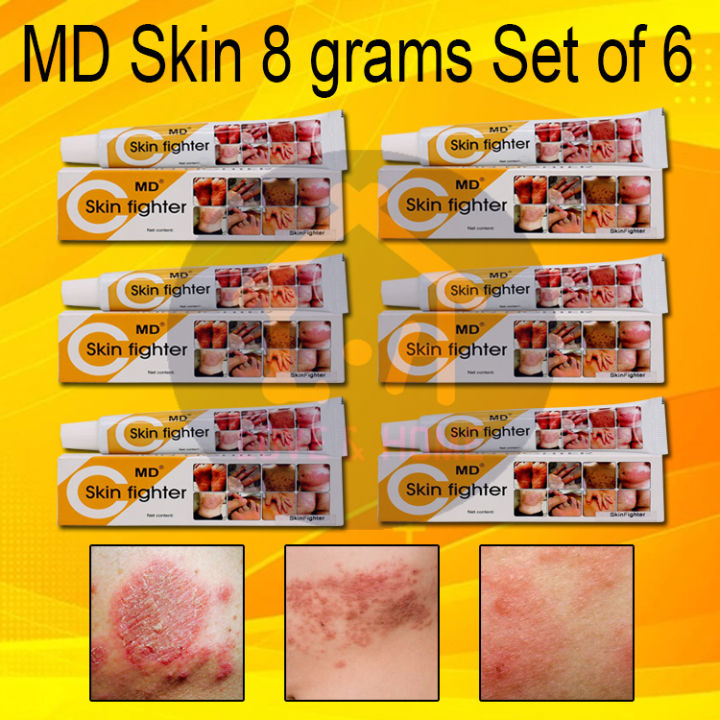 WISER Original MD Skin Fighter Cream for Skin Allergies or Fungis 8g ...