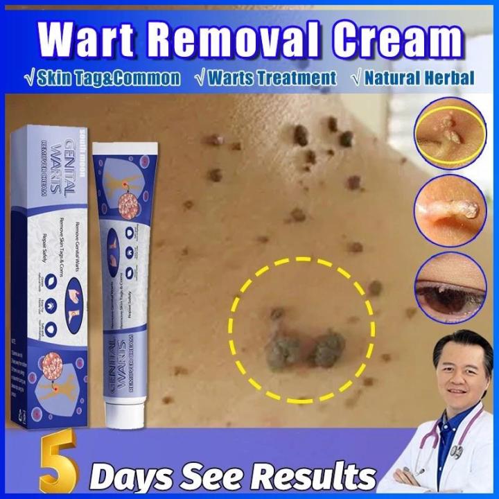 Genital Wart Removal Cream Ubat buang kutil ketuat tahi lalat biji ...