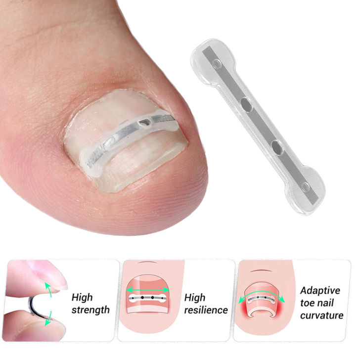 GlowHealthH Ingrown Toenail Correction Tool Ingrown Toe Nail Treatment ...