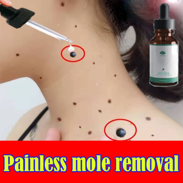 Facial Moles Removal Essential Oil 祛痣精华 Efficient Lightening Skin Serum ...