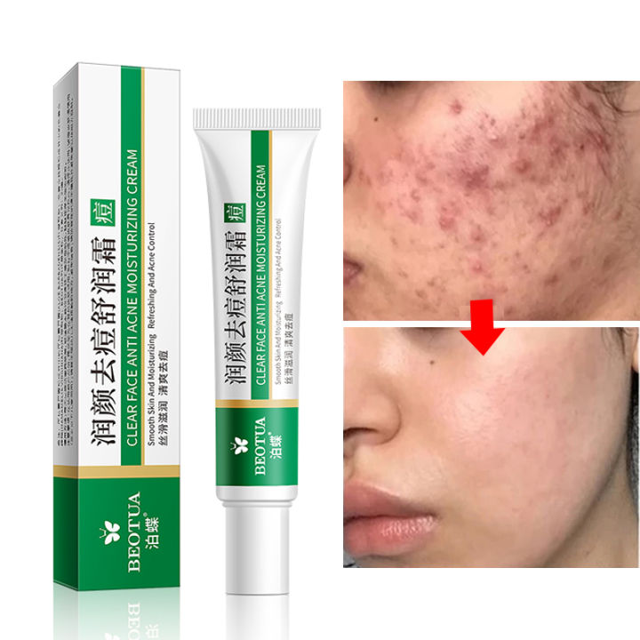 20g Effective Acne Removal Cream Herbal Acne Spots Oil Control Acne ...