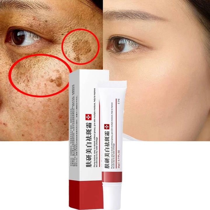 Whitening freckle cream acne remover niacinamide skin cream brightening ...