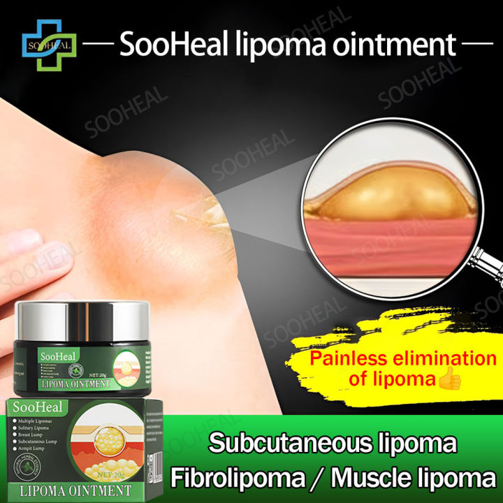【SOOHEAL】Lipoma removal cream 20g Effectively remove subcutaneous fat ...