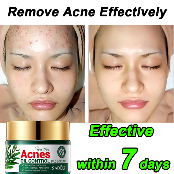 100% Effective Pimple Marks Remover Fades Acne Scars And Repairs Acne Scars Acne Spot Treatment ...