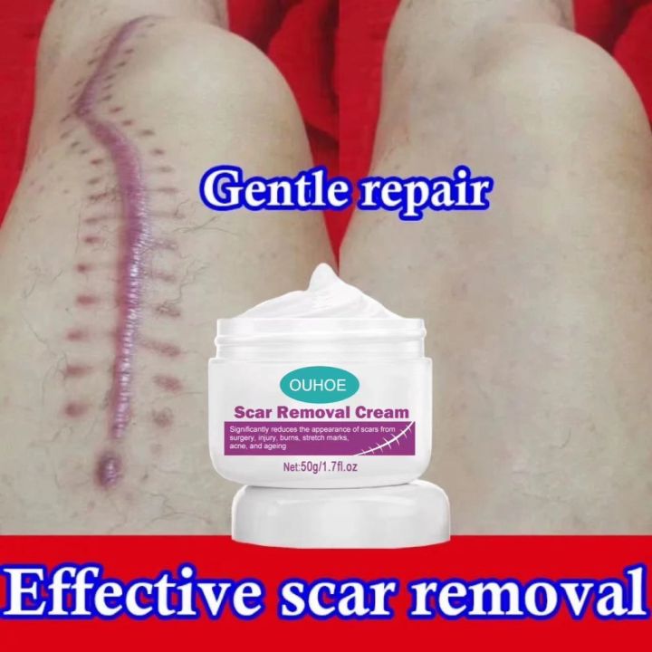 Original Scar Remover Cream Peklat Remover Cream For Old Scars Stretch