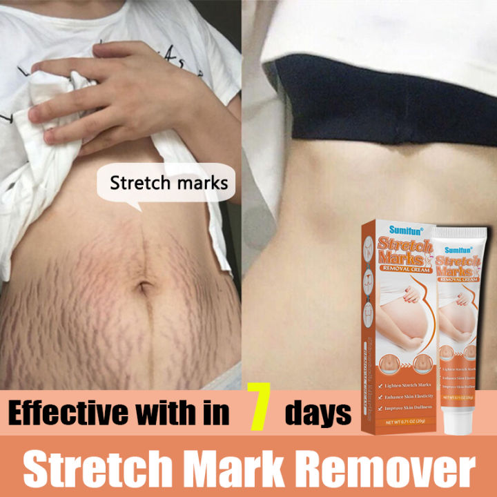 Strechmark Removal Original Remove Stretch Marks Cream Anti Wrinkle ...