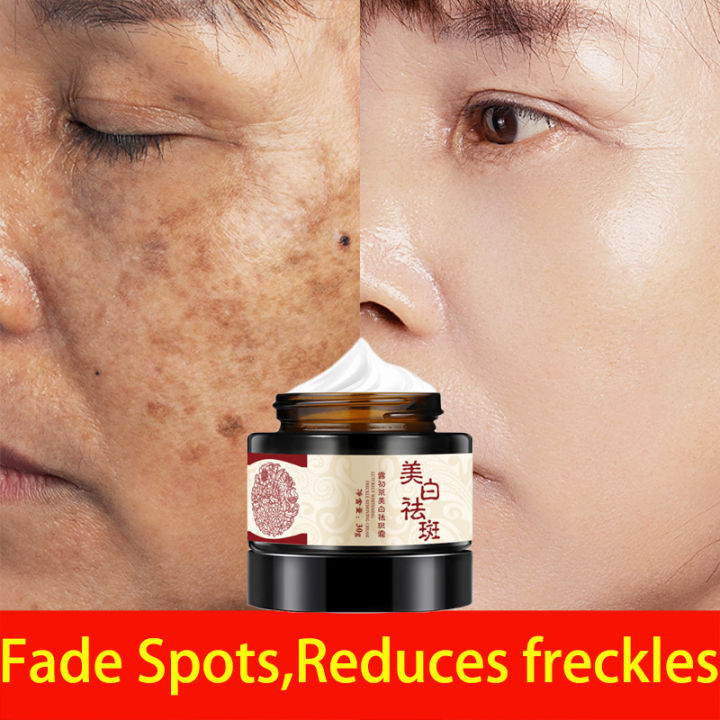 Freckle Cream, Freckle Removal cream, Whitening Cream, Blemish Inhibits ...
