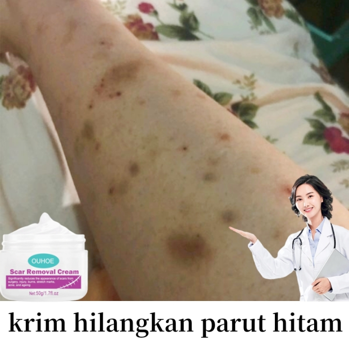 Scar Remover Cream Old Scar Remover Cream For Legs Peklat Remover ...