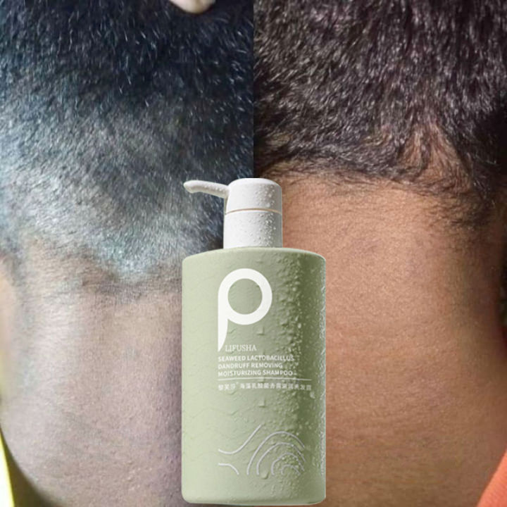 Original Anti Dandruff shampoo, Dandruff Remover, Anti Fungal, Anti ...