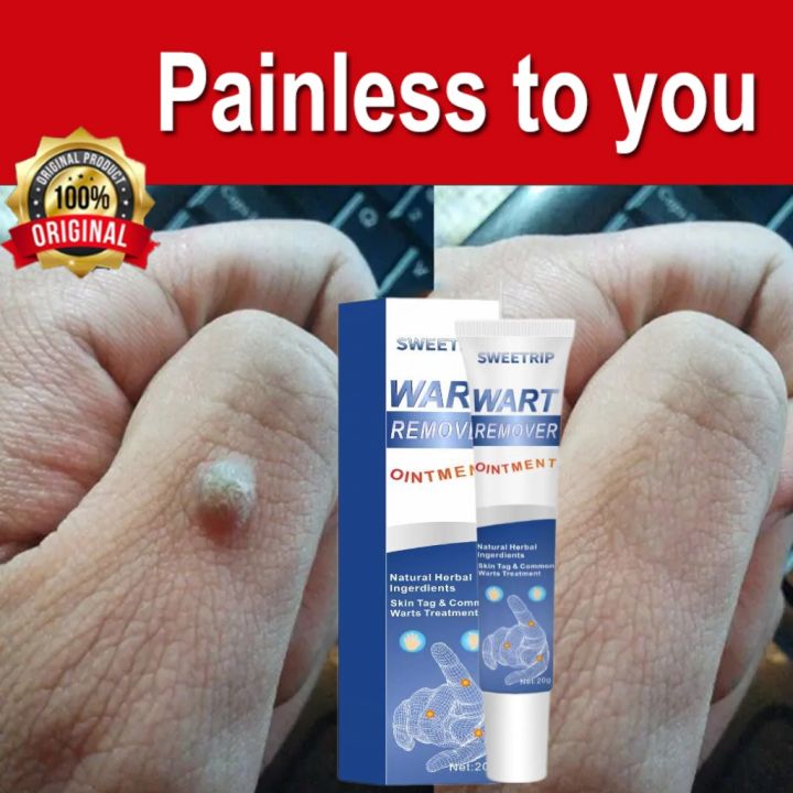 Warts Remover Original Cream 20g Painless Warts Magic Remover Wartz ...
