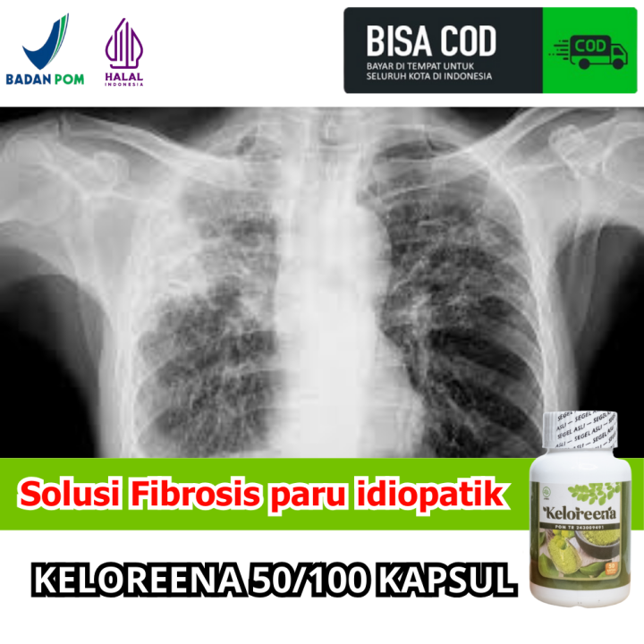Obat Fibrosis Paru Idiopatik,Sesak Nafas,Batuk Kering,Kelelahan, Nyeri ...